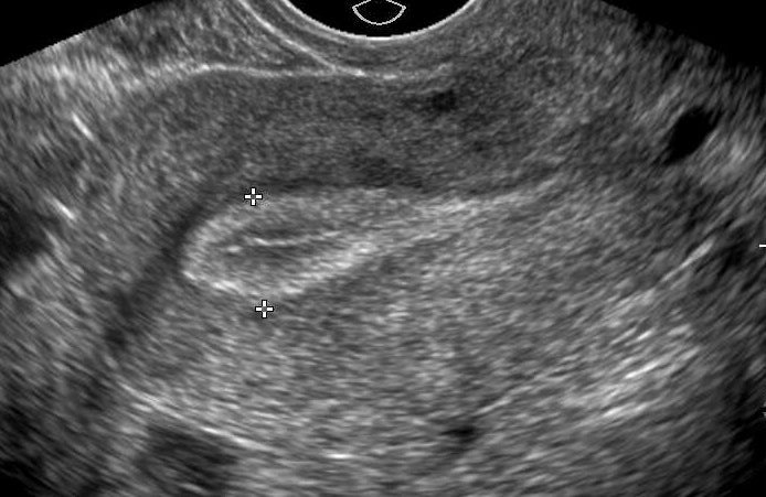 Endometrial Lining & Follicle Tracking Scan for IVF - Cheltenham ...